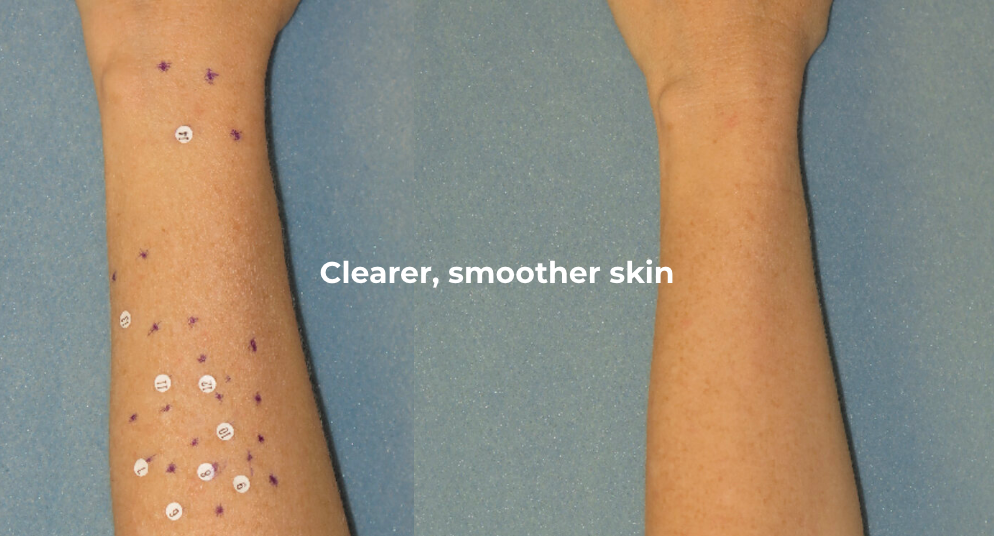 Why LEVULAN and benefits BLU-U | LEVULAN® KERASTICK® (aminolevulinic ...