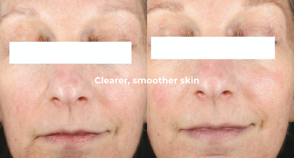 Why LEVULAN and benefits BLU-U | LEVULAN® KERASTICK® (aminolevulinic ...